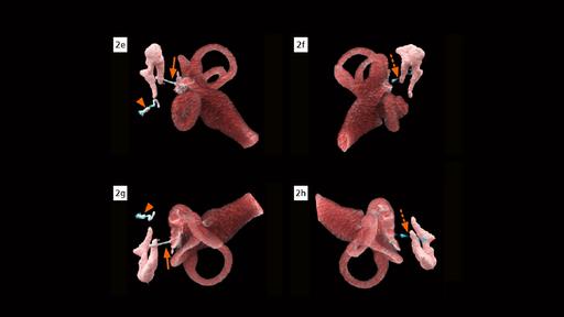 Stapes prosthesis dislocation - Siemens Healthineers USA
