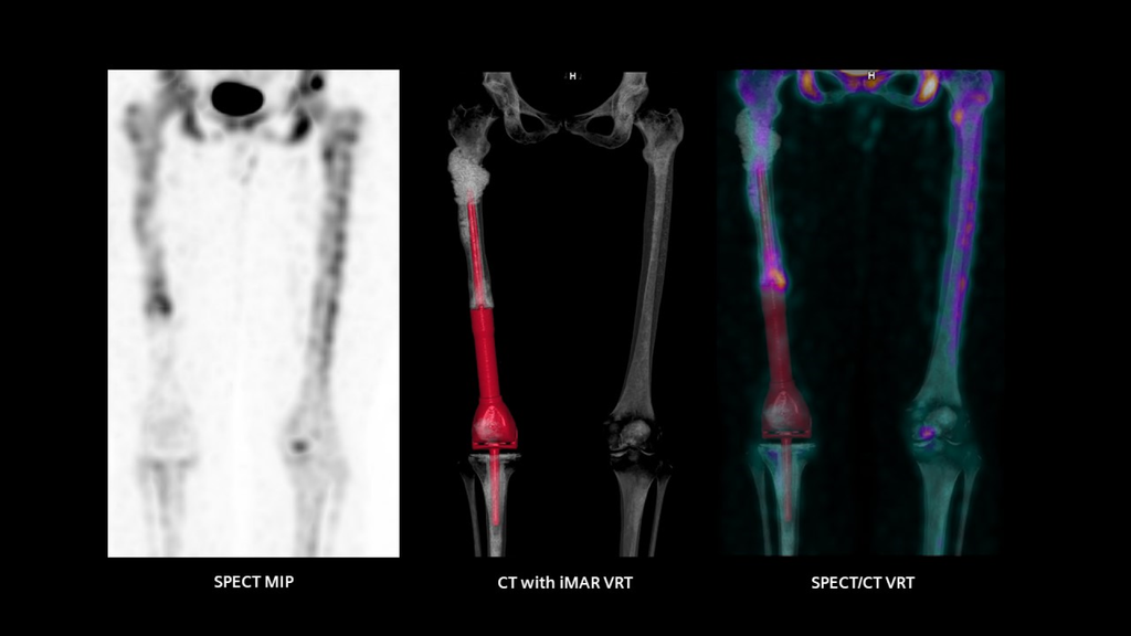 SPECT/CT in musculoskeletal medicine - Siemens Healthineers