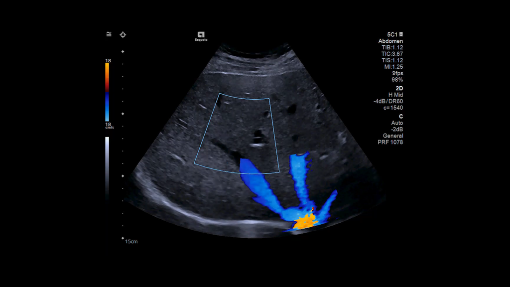 ACUSON Sequoia Ultrasound System - Siemens Healthineers