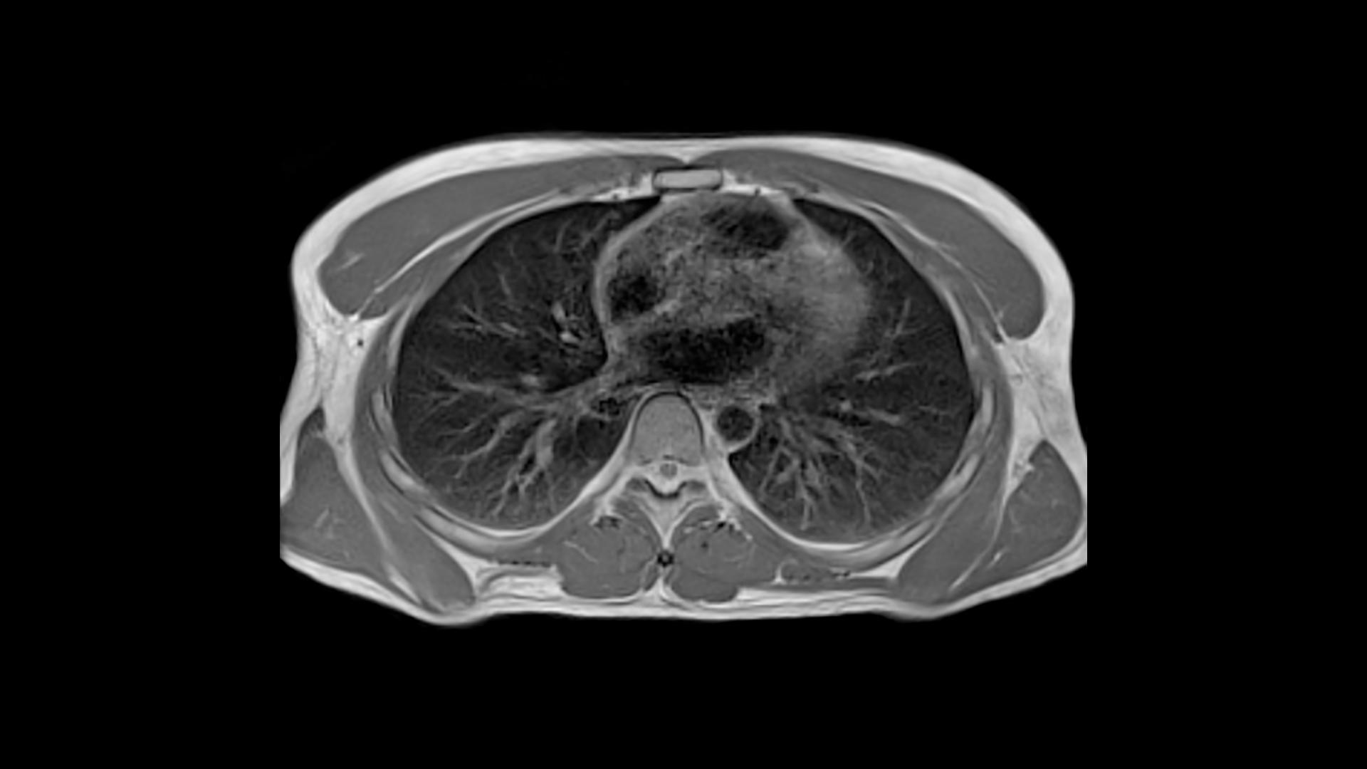 MAGNETOM Free.Max – Open Bore MRI - Siemens Healthineers USA