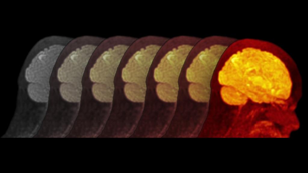 PETNET on neurology - Siemens Healthineers USA