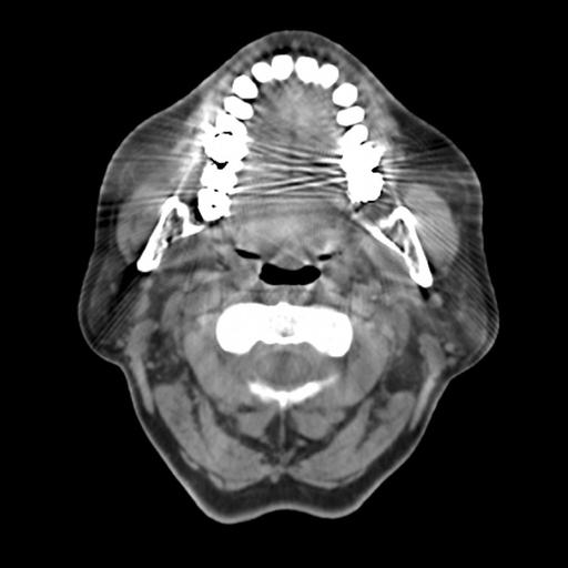 iMAR - Iterative Metal Artifact Reduction - Siemens Healthineers USA