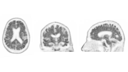 Beta-amyloid PET/CT imaging for Alzheimer's disease - Siemens Healthineers