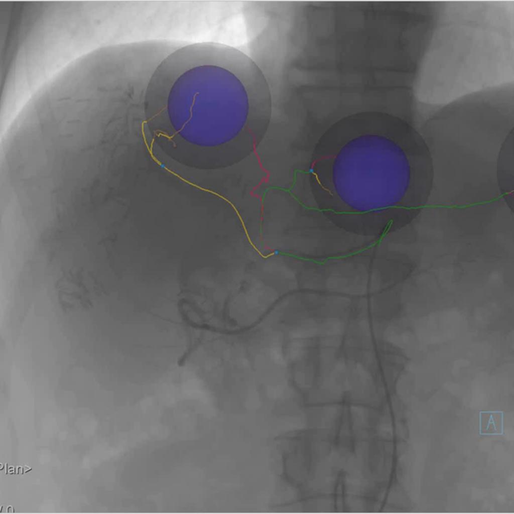 Interventional Oncology Procedures - Siemens Healthineers
