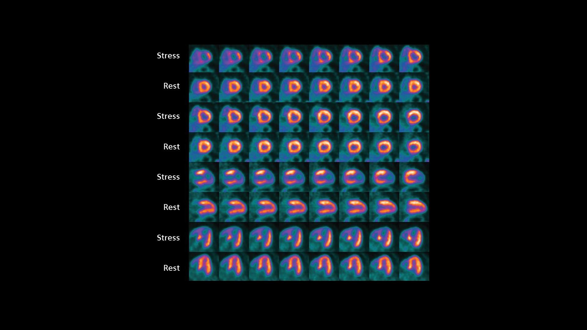 PET/CT delineation of multivessel coronary artery disease and post ...