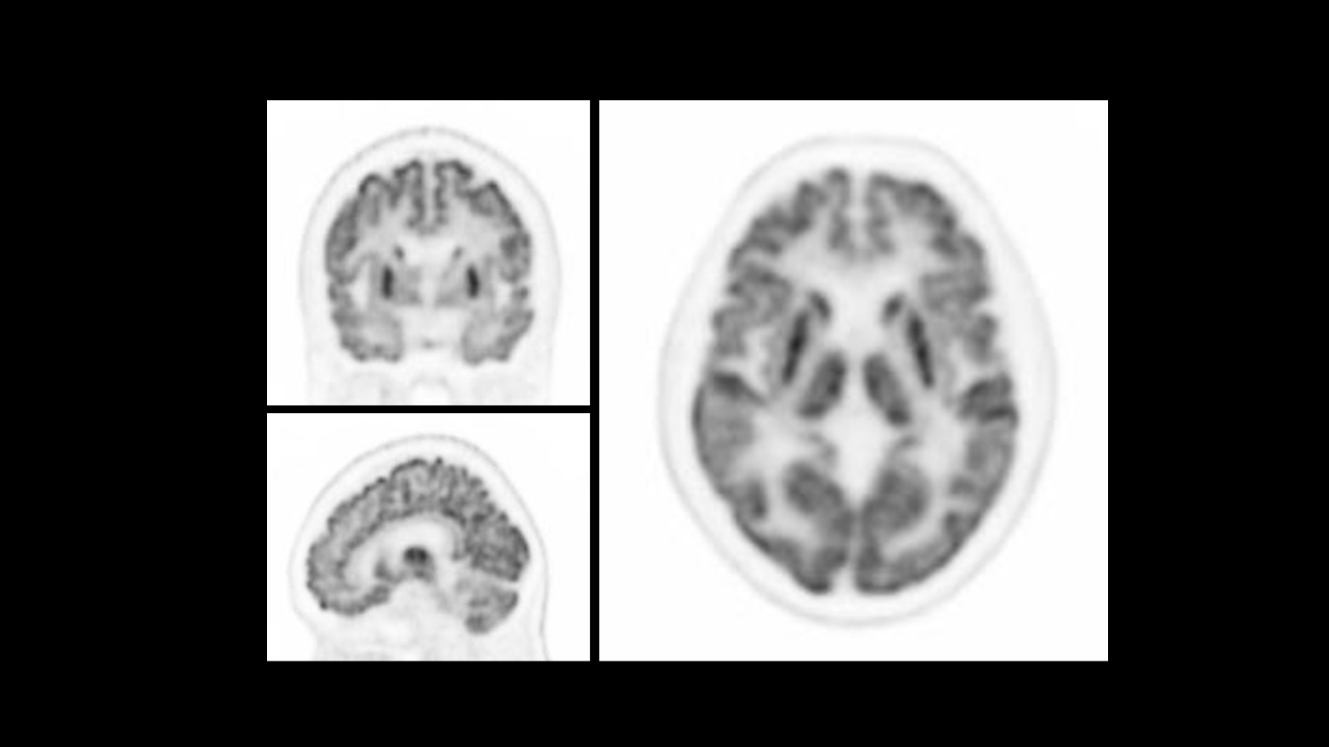 Beta-amyloid PET/CT imaging for Alzheimer's disease - Siemens Healthineers