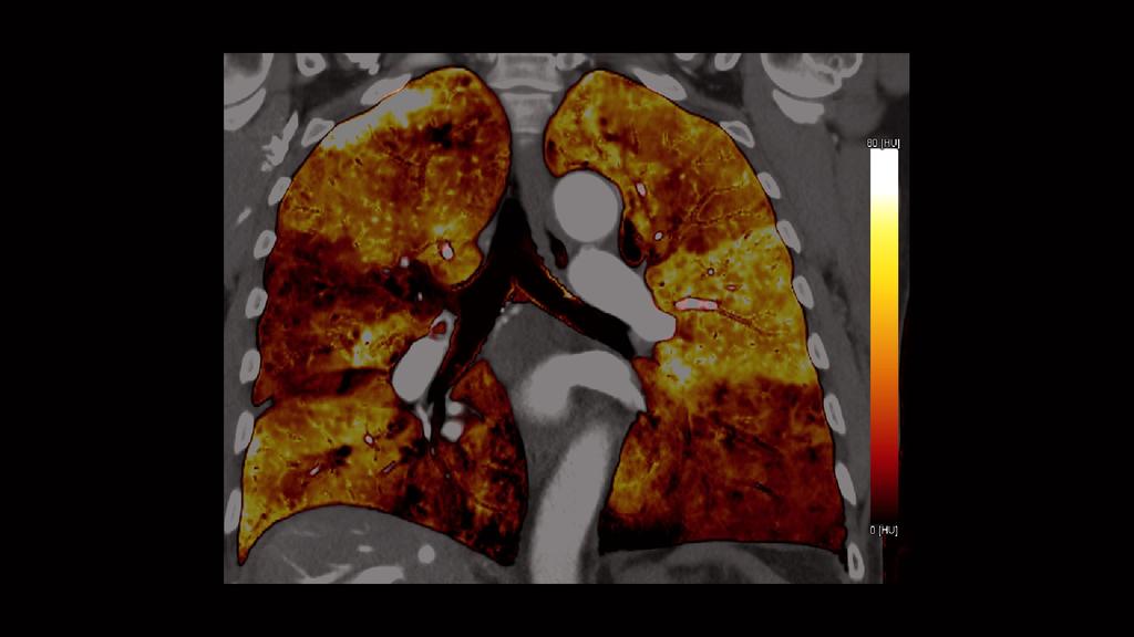 Chronic thromboembolic pulmonary hypertension diagnosed after COVID-19 ...