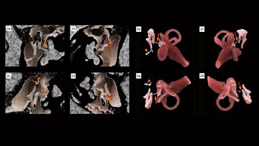 Stapes prosthesis dislocation Siemens Healthineers Nederland