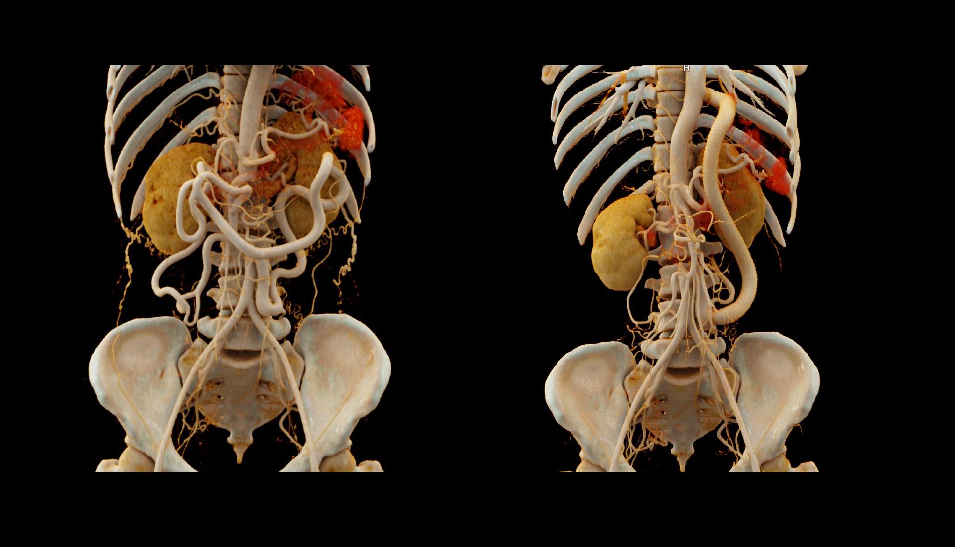 An infrarenal aortic occlusion in a young adult - Siemens Healthineers ...