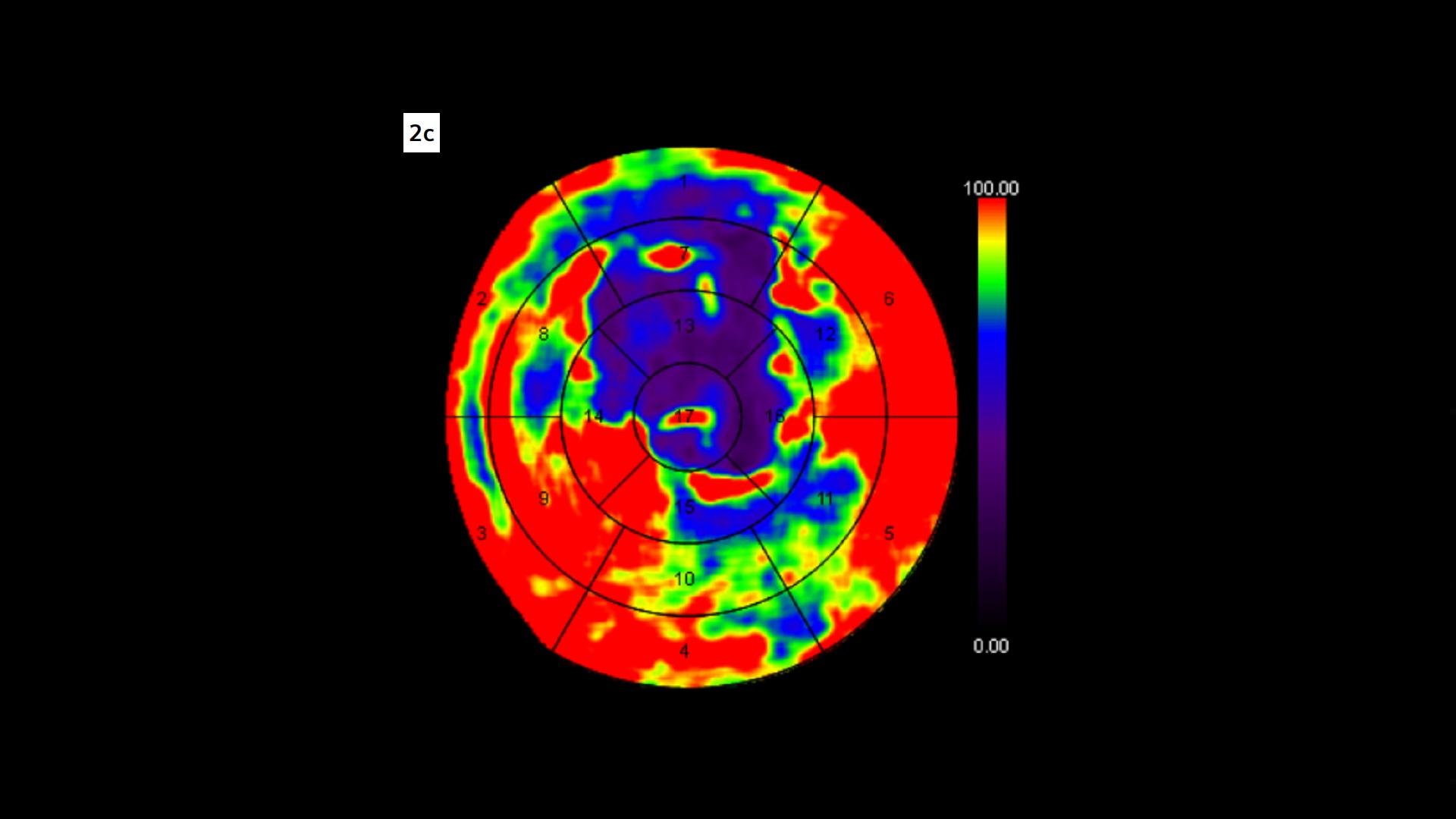 LAD occlusion – acute or chronic?