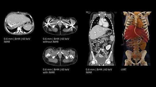 PCCT pediatric imaging - Siemens Healthineers USA