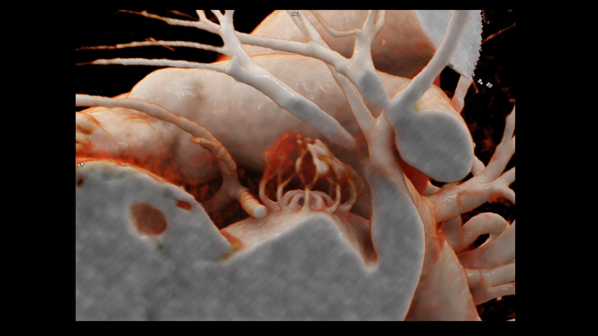 SOMATOM Pro.Pulse Dual Source CT scanner - Siemens Healthineers USA