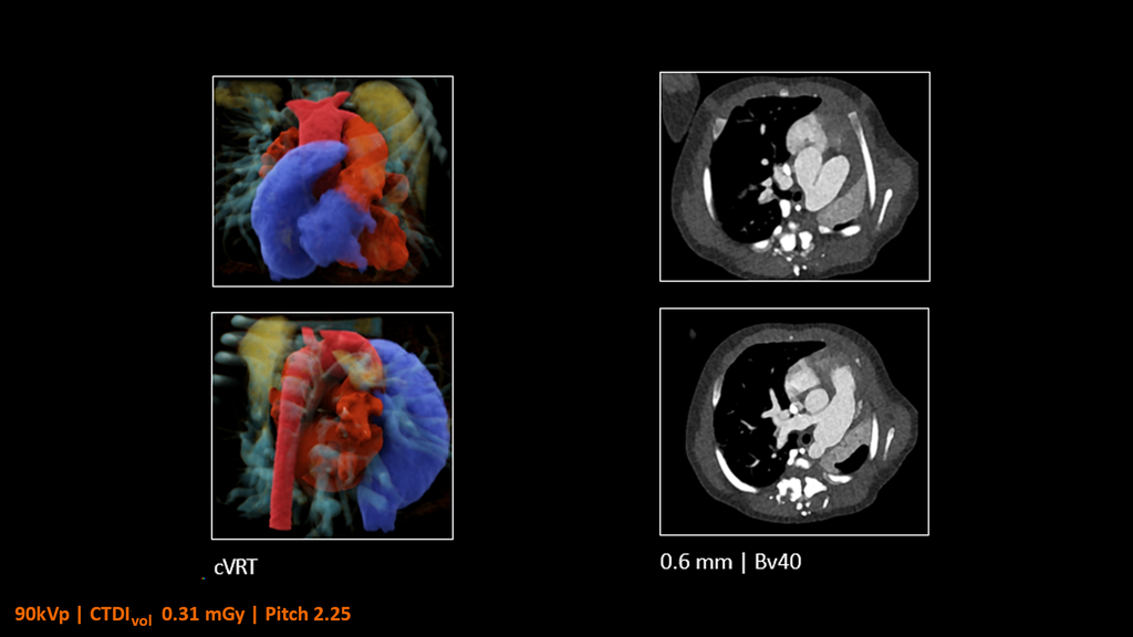 Dual Source CT - Siemens Healthineers