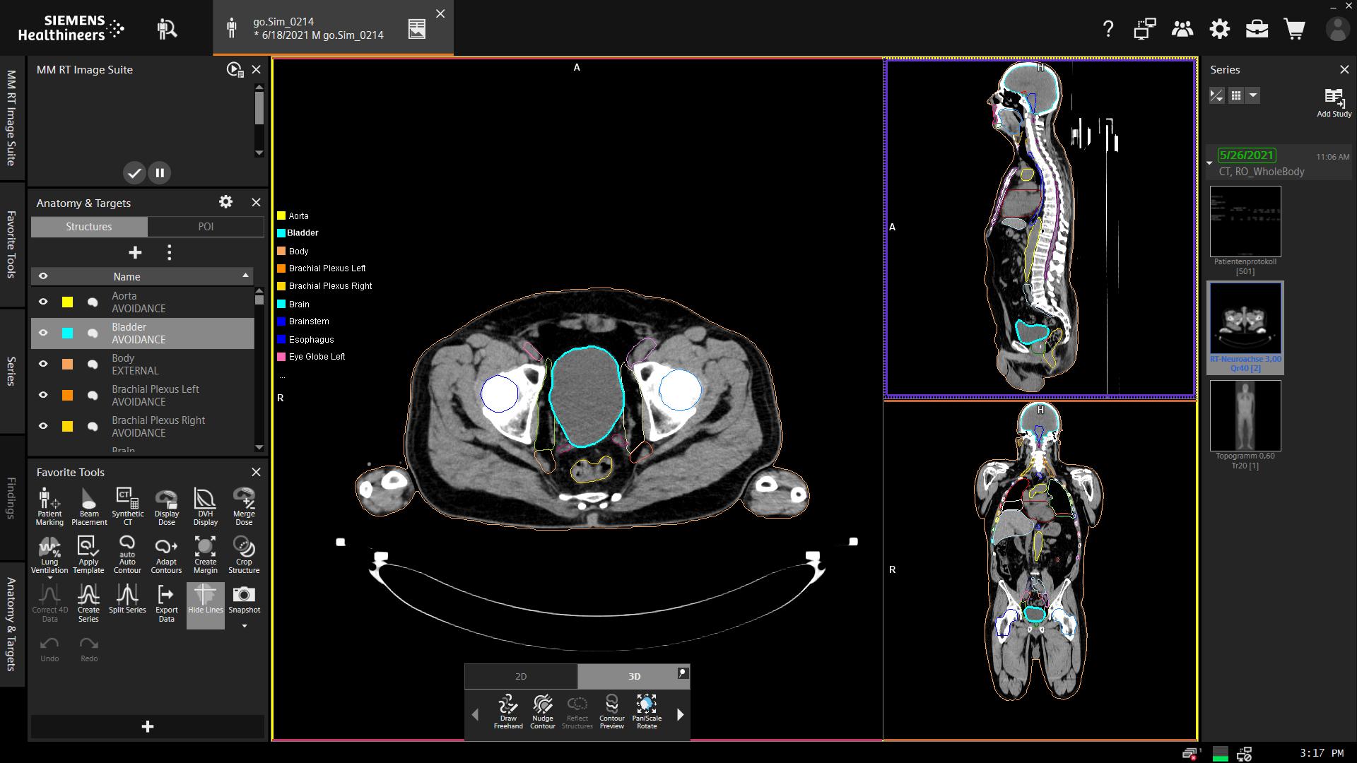 Autocontouring in radiation therapy - Siemens Healthineers - Siemens ...