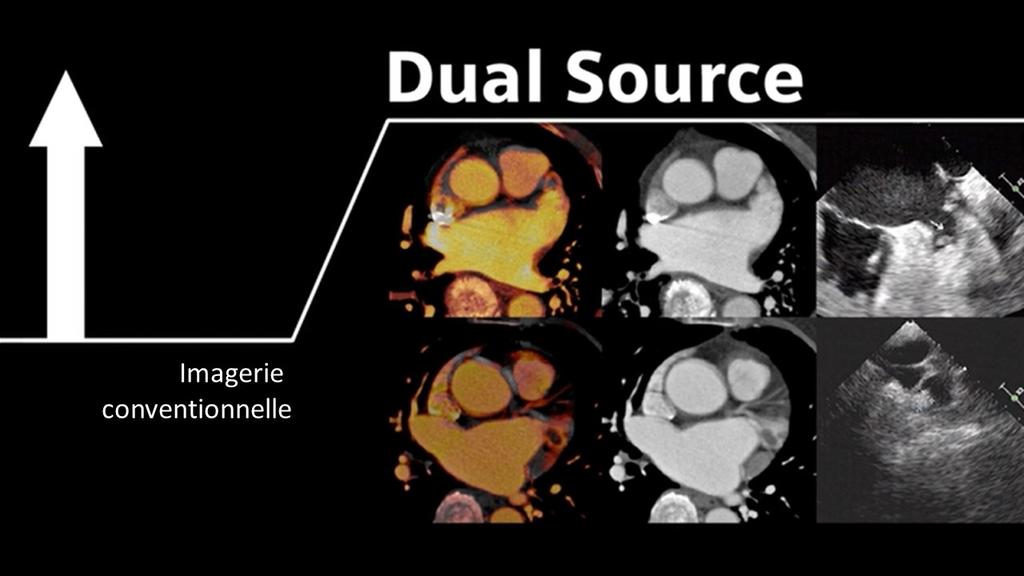 Scanner bi-tube en imagerie cardiaque - Siemens Healthineers France