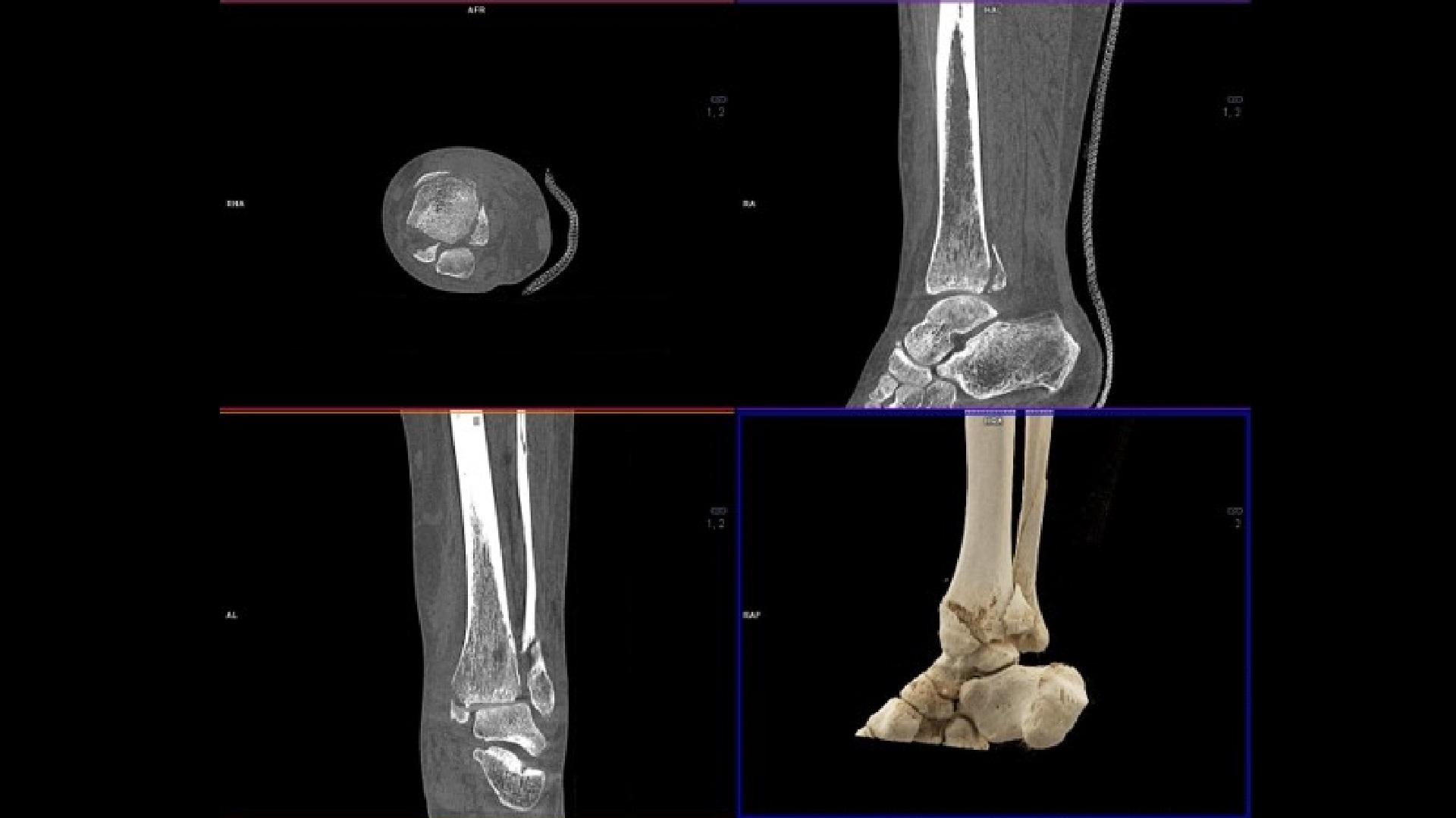Twin Robotic X-ray scanner – Multitom Rax - Siemens Healthineers USA