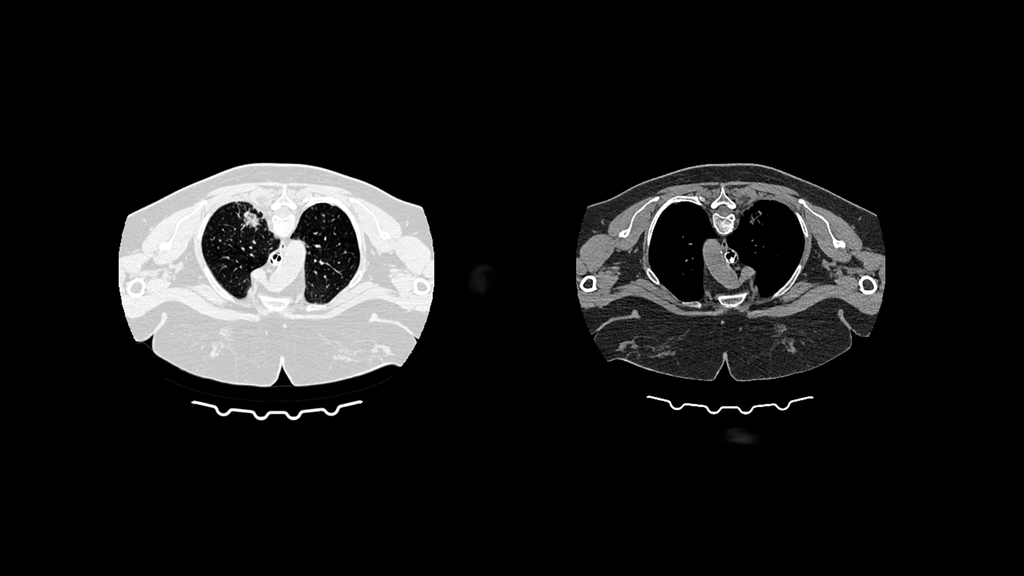 CT-guided interventional procedures on SOMATOM go.platform - Siemens ...