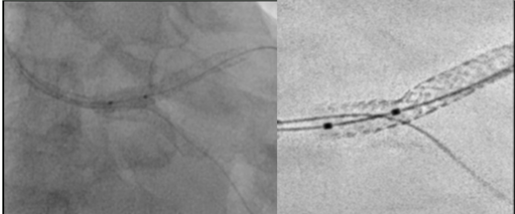 Enhanced stent visualization assists in improving the outcome of ...