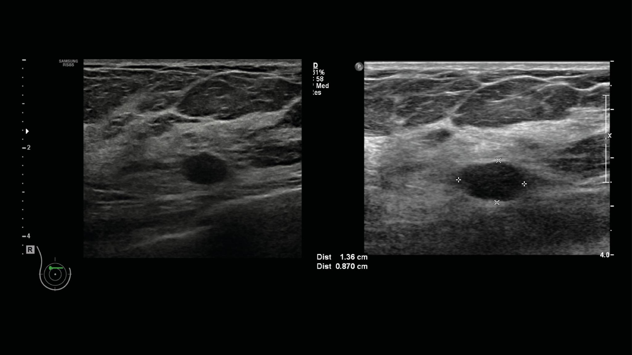 Identificación de Carcinoma lobular invasivo grado 3 por tomosíntesis ...