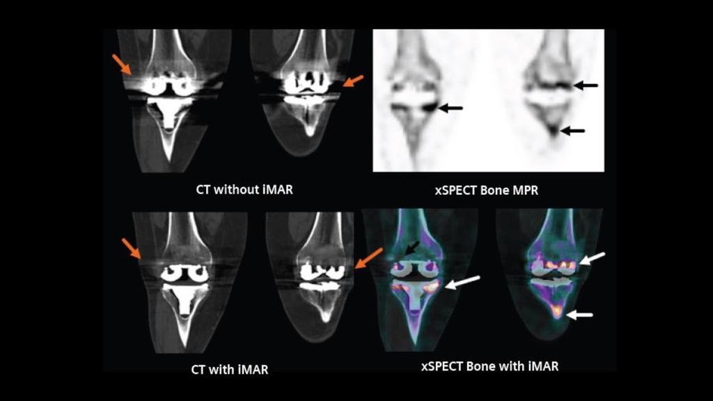 SPECT/CT Detection In TKA Prosthetic Loosening