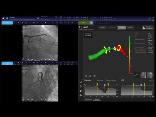 Rethink FFR assessment for every patient - Siemens Healthineers