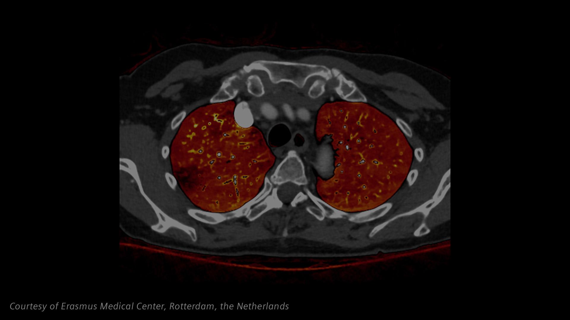 NAEOTOM Alpha.Pro - Siemens Healthineers