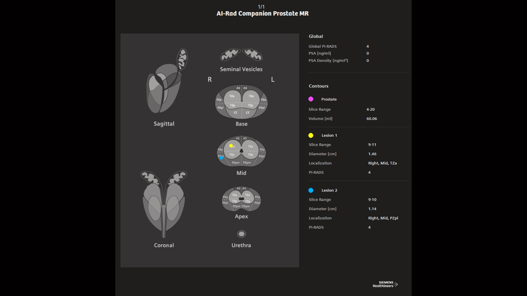 AI-Rad Companion - Siemens Healthineers
