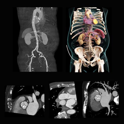 CT Cardiovascular Imaging - Siemens Healthineers USA