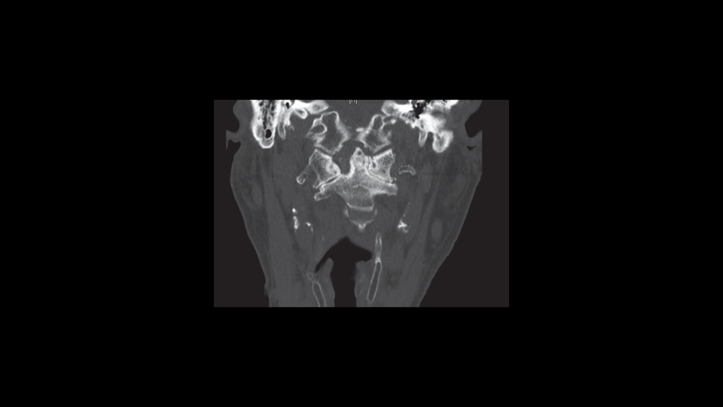 The use of SPECT/CT in a musculoskeletal Physical Medicine and ...