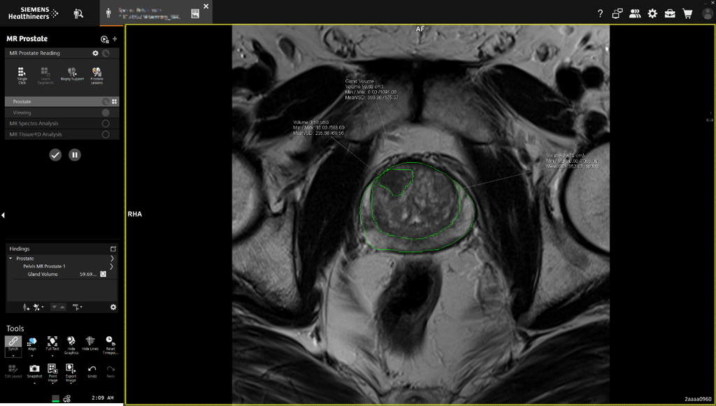 MR Prostate – AI-based segmentation and classification