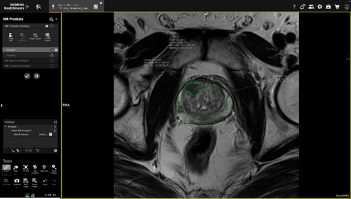 Mr Prostate Ai Based Segmentation And Classification