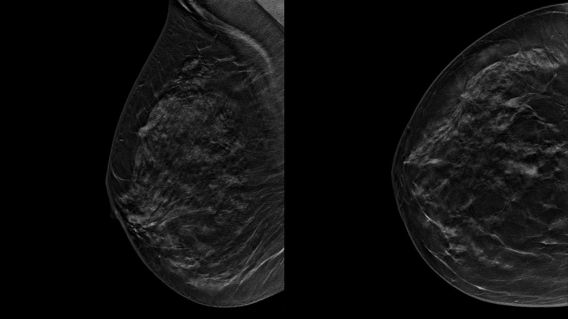 Breast Cancer Imaging at St. Anna, Luzern - Siemens Healthineers