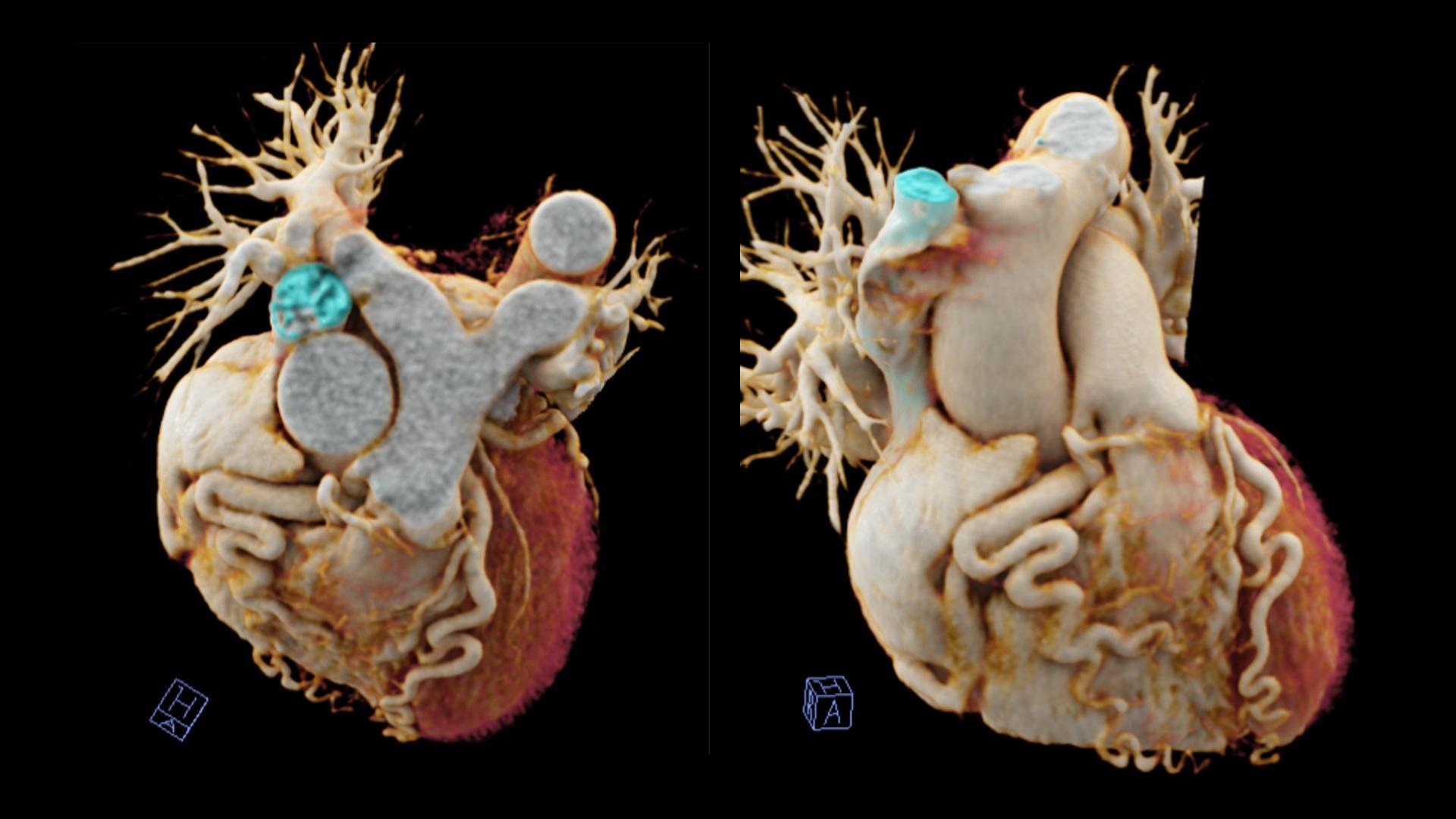 ARCAPA syndrome – an incidental finding in an adult - Siemens Healthineers