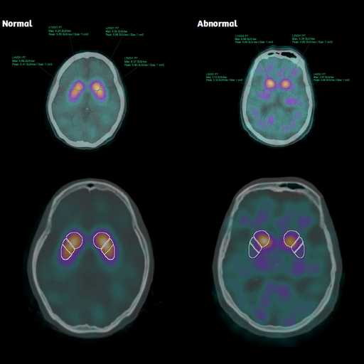 Evaluating SPECT/CT Quantification in Clinical Practice - Siemens ...