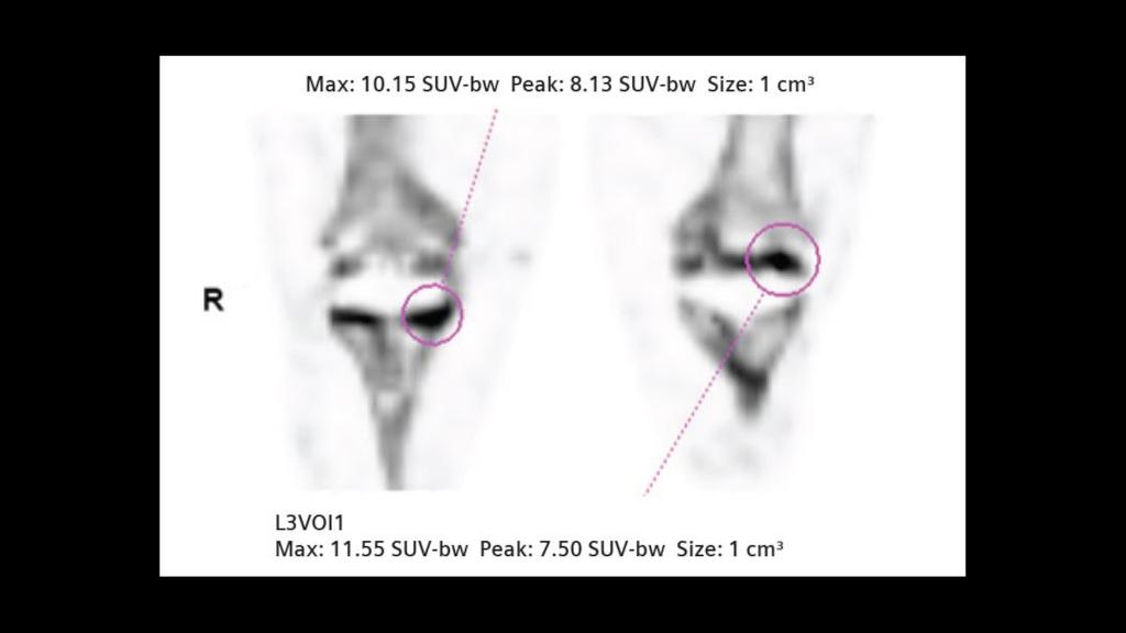 SPECT/CT Detection In TKA Prosthetic Loosening - Siemens Healthineers