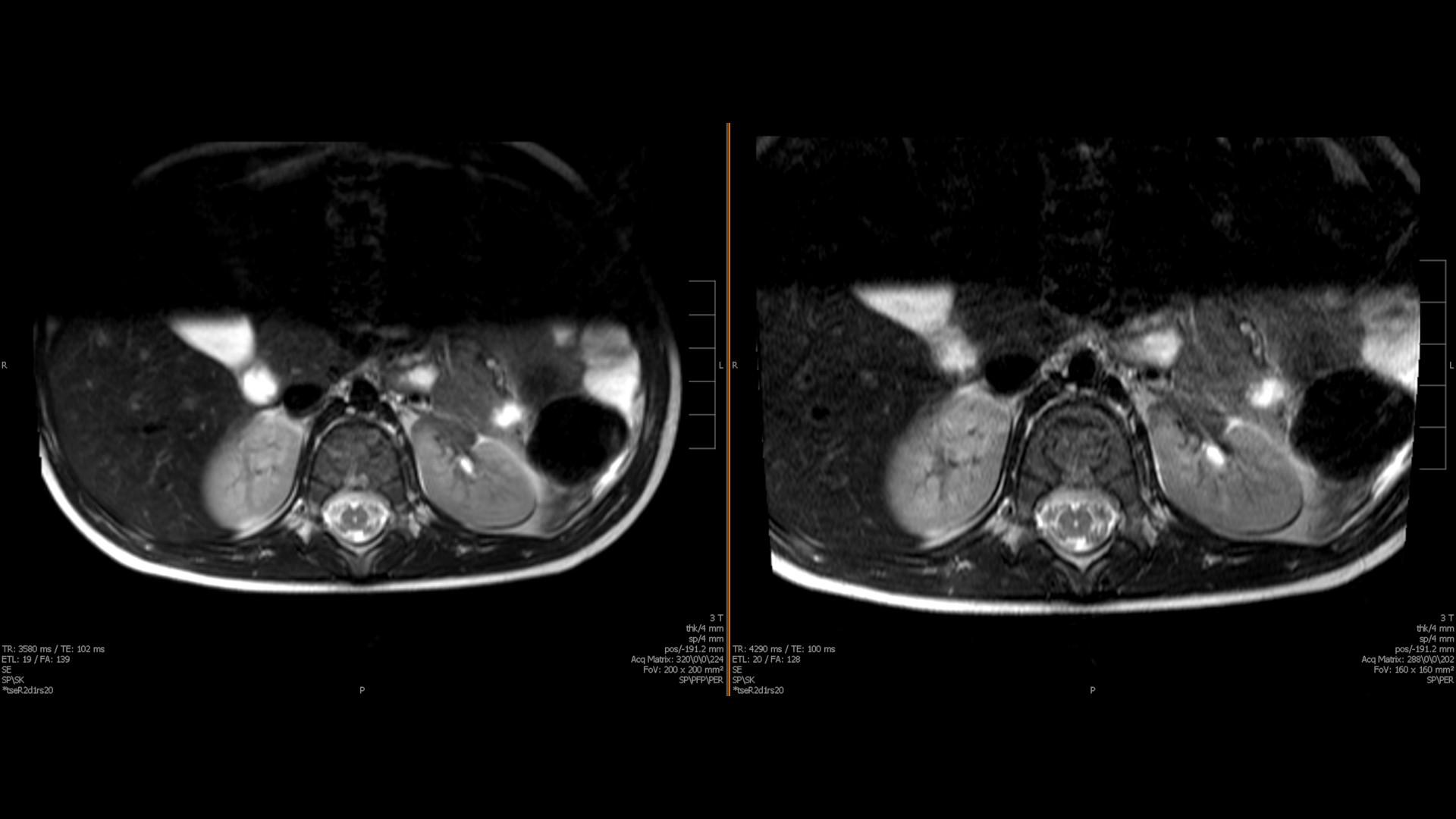 Pediatric protocols using Deep Resolve