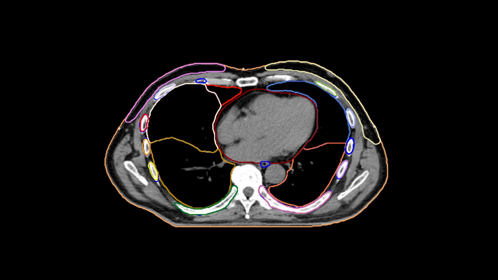 Autocontouring in Radiation Therapy - Siemens Healthineers - Siemens ...