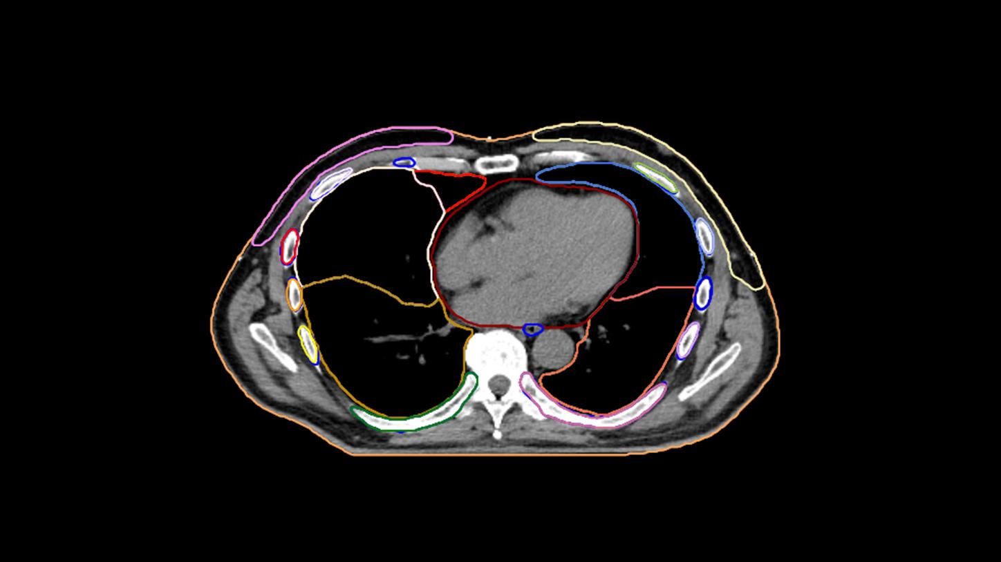 Autocontouring in Radiation Therapy - Siemens Healthineers - Siemens ...