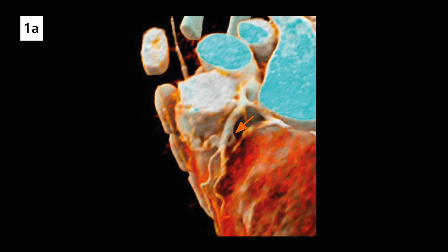 Fístula pediátrica de la arteria coronaria a la pulmonar - Siemens ...