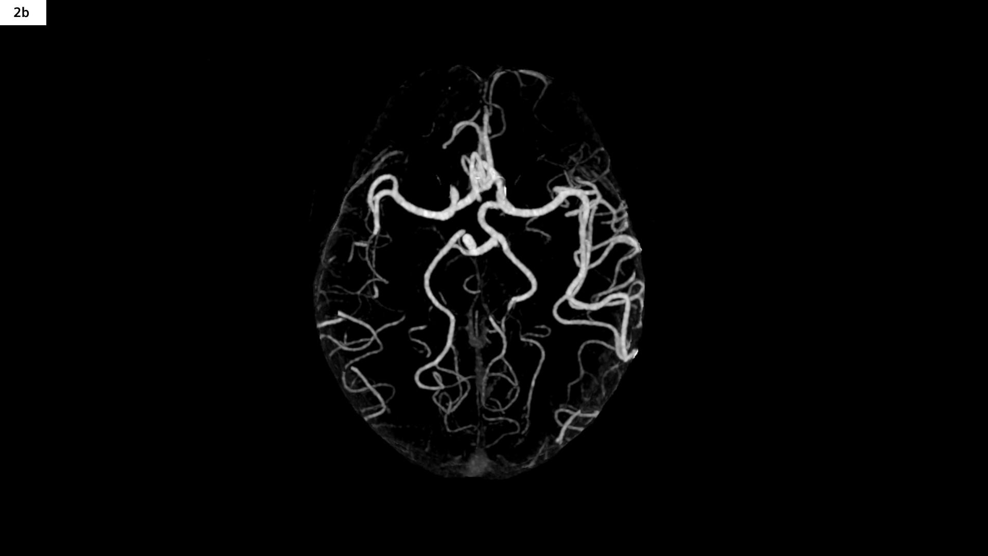 Massive carotid body tumor - Siemens Healthineers India
