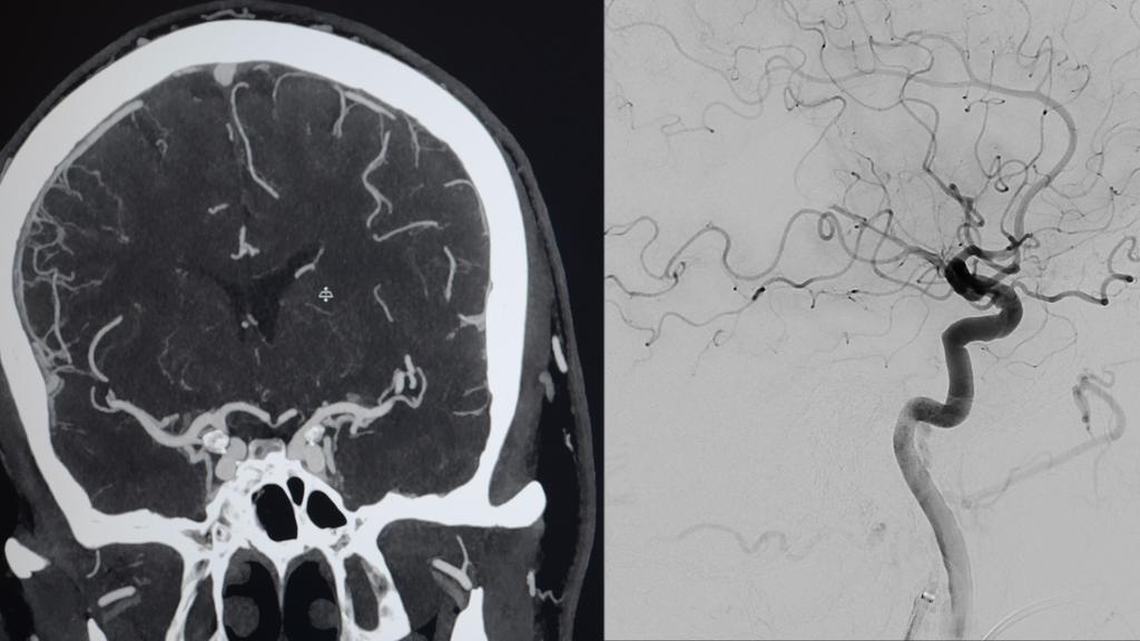 Improving the stroke pathway in southern Sweden