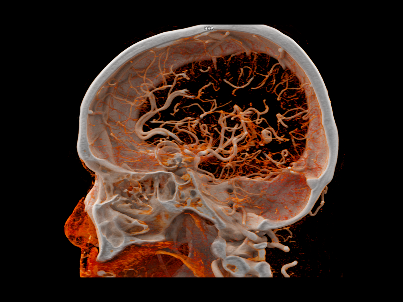 PCCT neurology imaging - Siemens Healthineers