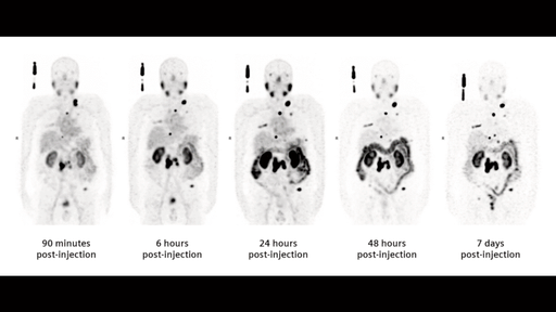 Tumor and organ dosimetry from sequential quantitative SPECT/CT - Siemens Healthineers