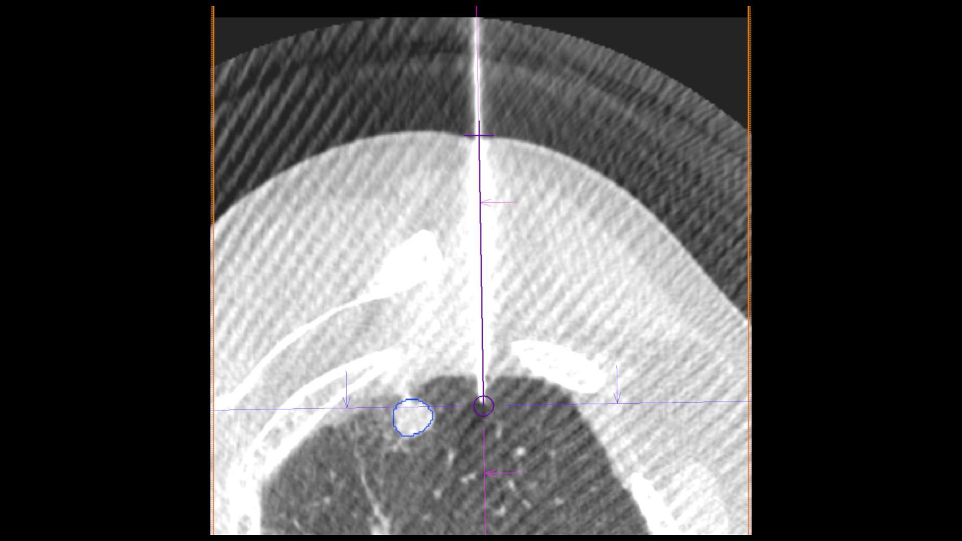 Diagnosis and treatment of lung cancer - Siemens Healthineers