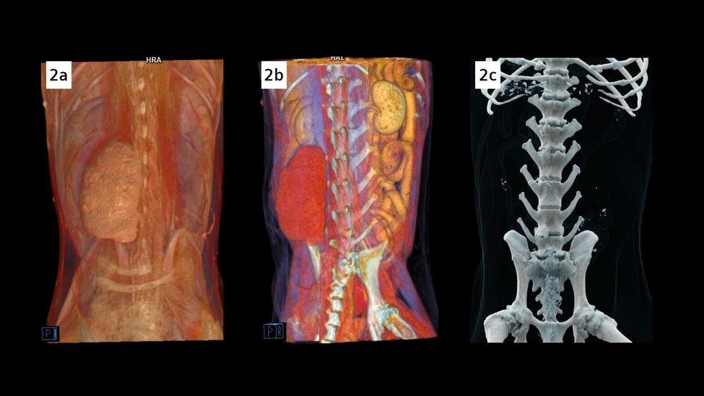 A massive paraspinal dermal hemangiosarcoma – palliative or surgical ...