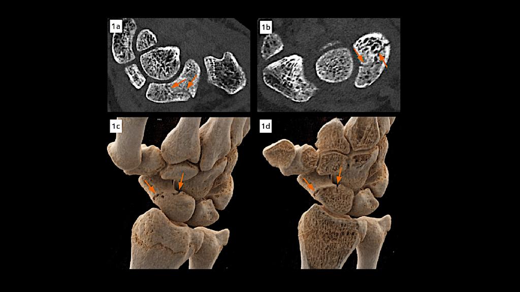 Scaphoid fracture only seen in CT - Siemens Healthineers