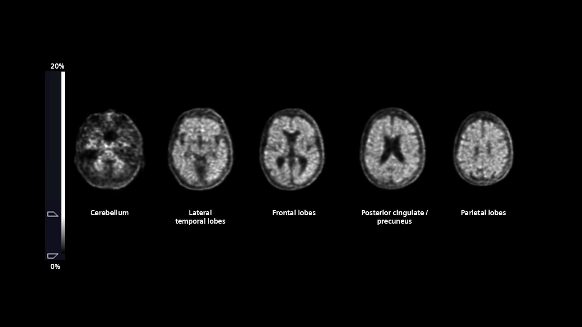 Beta-amyloid PET/CT imaging in the assessment for anti-amyloid monoclonal therapy - Siemens ...