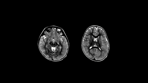 RESOLVE Diffusion Weighted Imaging clinical Pediatric Acute ...