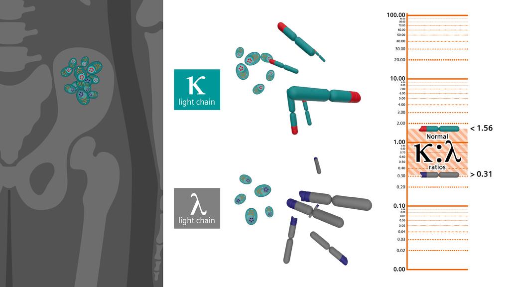 MGUS & progression to Multiple Myeloma - Siemens Healthineers Brasil