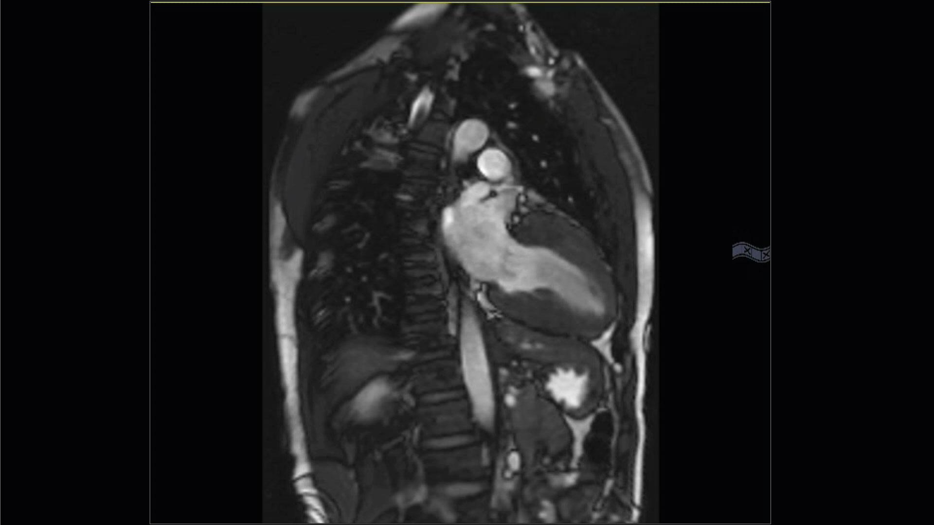 Fibrosis miocárdica: CRM sin electrodos de ECG - Siemens Healthineers ...